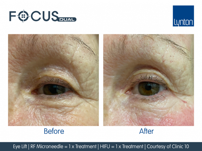 HIFU Facial · lunchtime face lift · The Lynton Clinic, Cheshire