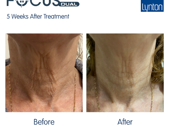 Focus Dual: the lunch time face lift explained · HIFU Facial · Lynton ...
