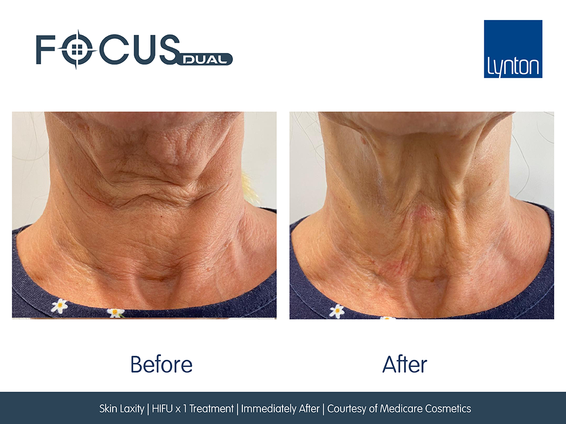 Focus Dual · Skin Lifting with RF Microneedling & HIFU · The Lynton Clinic