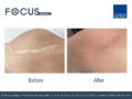 Focus Dual · Skin Lifting with RF Microneedling & HIFU · The Lynton Clinic
