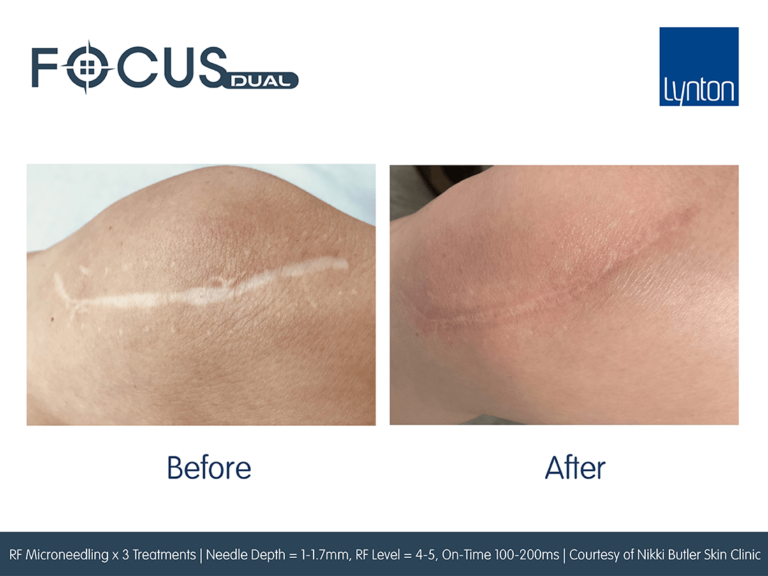 Focus Dual · Skin Lifting with RF Microneedling & HIFU · The Lynton Clinic